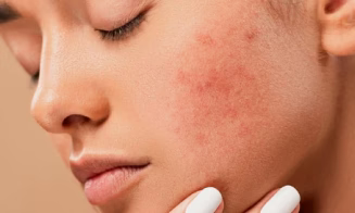 How to Stop Breakouts in Your Period