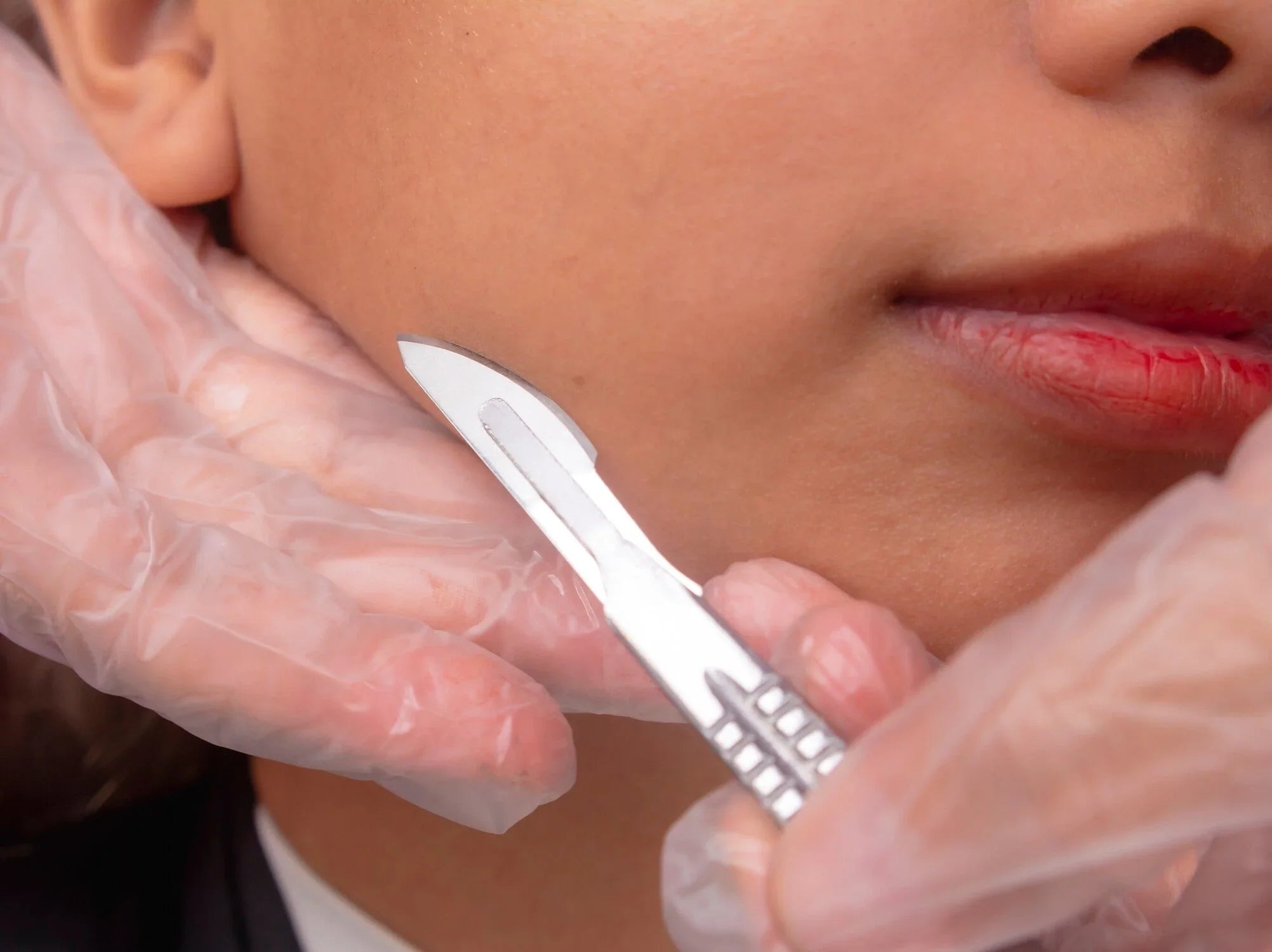 Can You Do Dermaplaning and Microneedling at the Same Time?